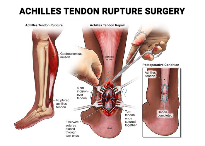 Achilles Tendon Rupture Surgery NJ Achilles Tendon Tear Repair