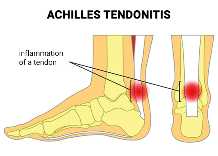 Achilles Tendon Rupture Surgery NJ Achilles Tendon Tear Repair