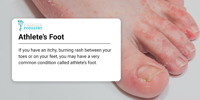 Athlete's Foot Specialist - Clifton, NJ: Premier Podiatry: Velimir ...