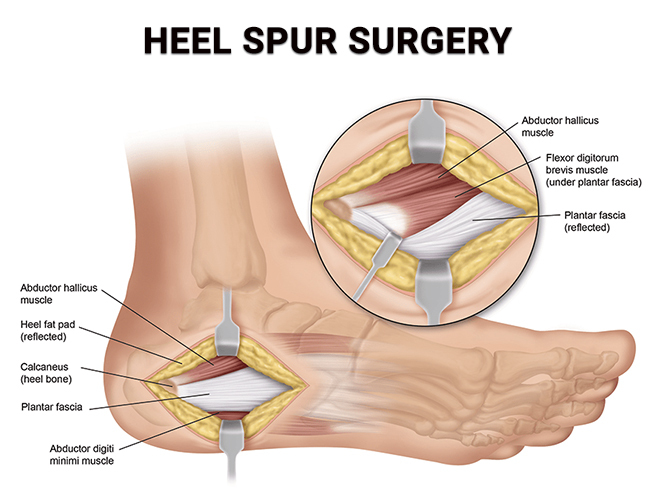 Bone Spur Heel Treatment Online Bellvalefarms Bone Spur Heel Treatment Online Bellvalefarms