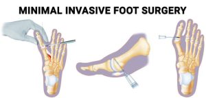Minimally Invasive Foot Surgery - Premier Podiatry: Velimir Petkov, DPM ...