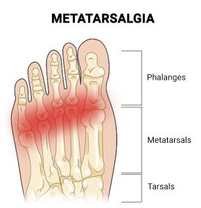 Ball of Foot Pain (Metatarsalgia) - Premier Podiatry: Velimir Petkov ...