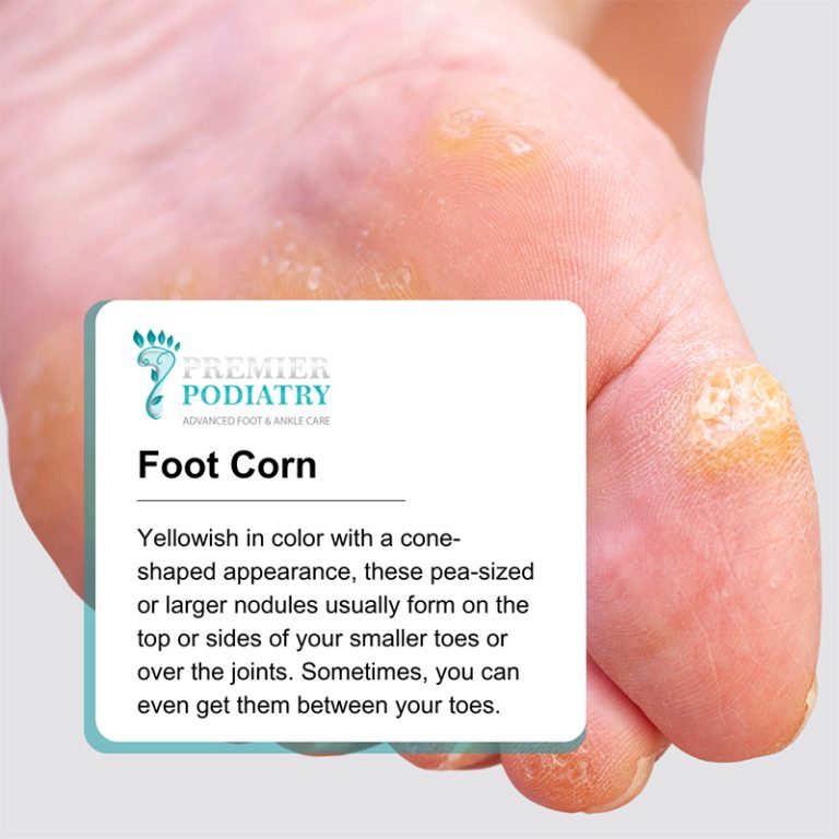 Corns - Premier Podiatry: Velimir Petkov, DPM: Podiatrists: Clifton, NJ