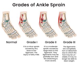 What to Know About a Foot Sprain | Premier Podiatry: Velimir Petkov ...