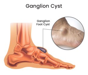What Causes a Ganglion Cyst on Your Foot and Ankle? | Premier Podiatry