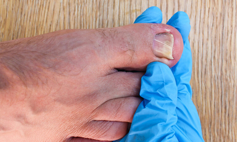 How to Remove an Ingrown Toenail | Premier Podiatry