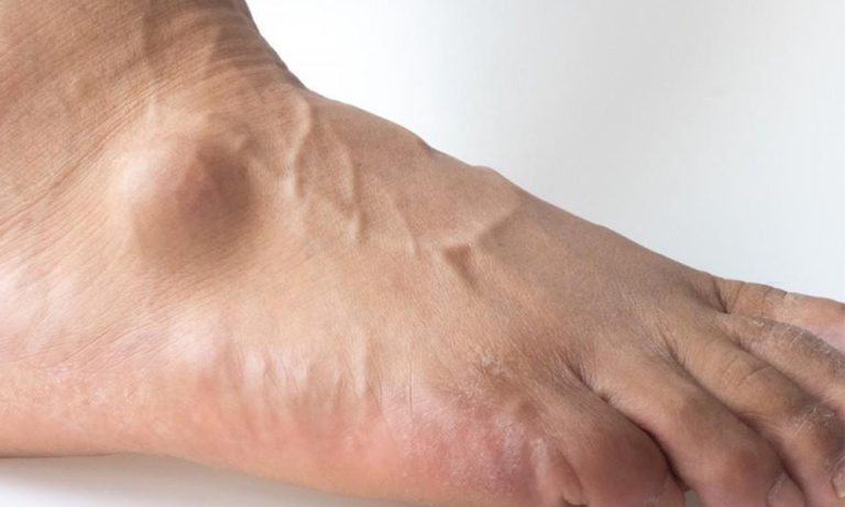 What Causes a Ganglion Cyst on Your Foot and Ankle? | Premier Podiatry