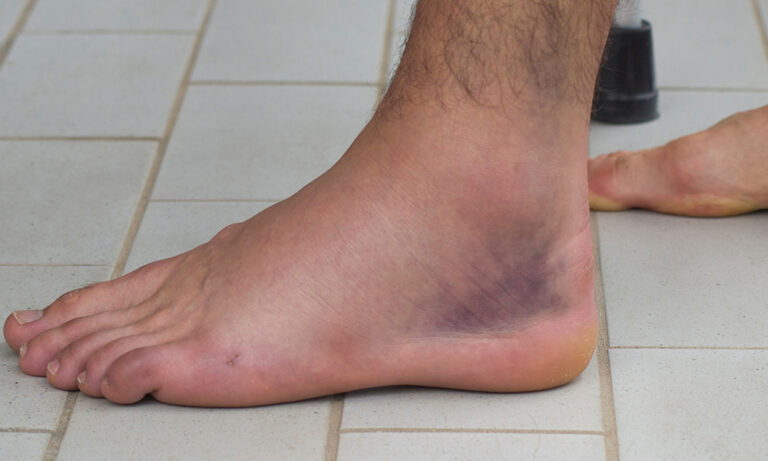 What to Know About a Foot Sprain | Premier Podiatry: Velimir Petkov ...